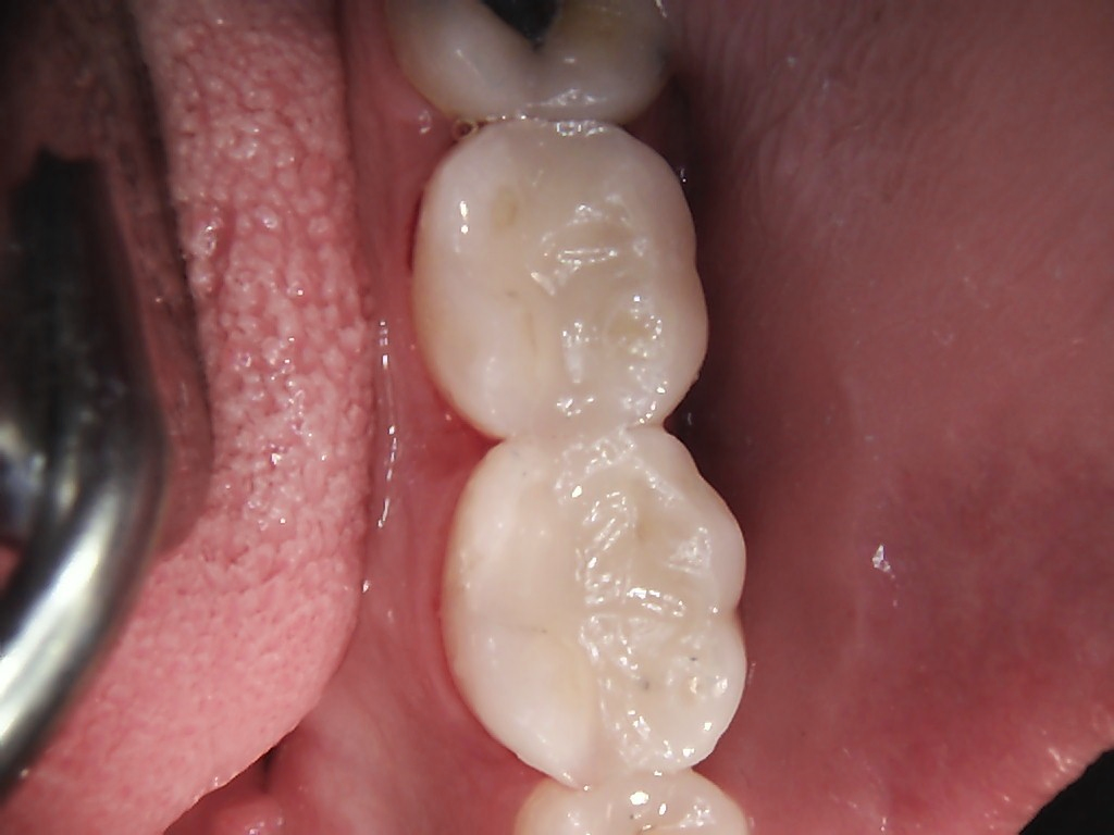 The Hidden Decay - Smile Loft Dentistry